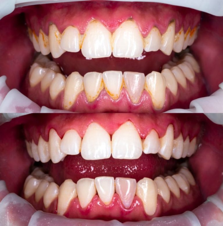 Teeth Cleaning In Turkey | Prices - TurDent