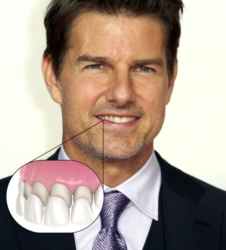 Tom Cruise’s Teeth | Your Perfect Smile in the Parmire