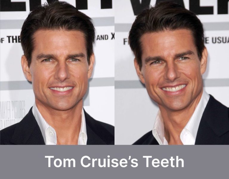 Tom Cruise’s Teeth | Your Perfect Smile in the Parmire